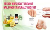 18 Easy Ways How To Remove Nail Fungus Naturally And Fast
