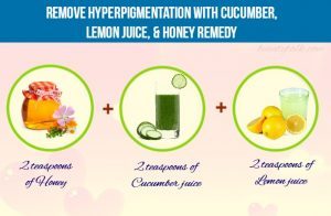 34 Ways How To Get Rid Of Hyperpigmentation Naturally