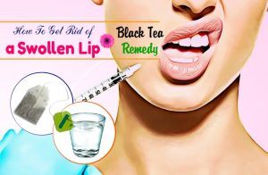 Top 15 Ways How To Get Rid Of A Swollen Lip Fast & Naturally