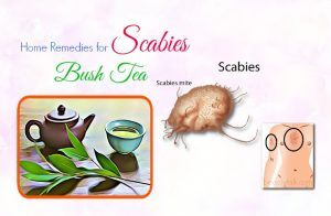 16 Science-Based Natural Home Remedies For Scabies That Work