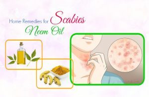 16 Science-Based Natural Home Remedies For Scabies That Work