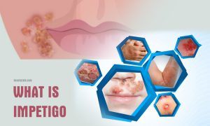 What Is Impetigo - Causes, Symptoms, Treatment, & Prevention