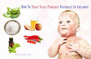 16 Ways How To Treat Scalp Psoriasis In Children & While Pregnant